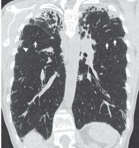 胸部HRCTパターンと病理学的なUIPとの関連性 | 呼吸器内科医のブログ LungDr Note