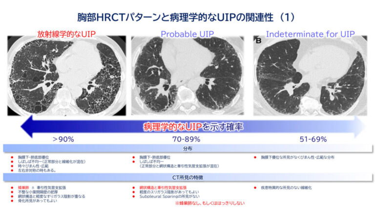 胸部HRCTで蜂巣肺・多発嚢胞・気腫を鑑別してみる | 呼吸器内科医のブログ LungDr Note