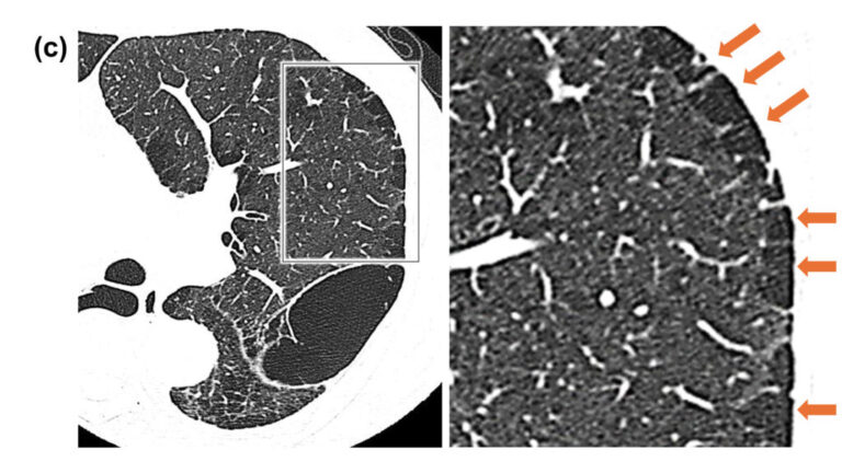 胸部HRCTで蜂巣肺・多発嚢胞・気腫を鑑別してみる | 呼吸器内科医のブログ LungDr Note