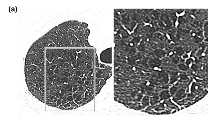 胸部HRCTで蜂巣肺・多発嚢胞・気腫を鑑別してみる | 呼吸器内科医のブログ LungDr Note