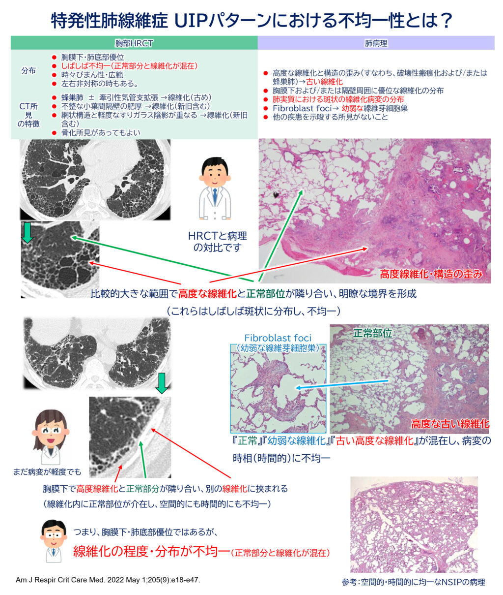 UIPにおける時間的および空間的な不均一性とは？ ―肺の病理・胸部HRCTの観点で解説― | 呼吸器内科医のブログ LungDr Note