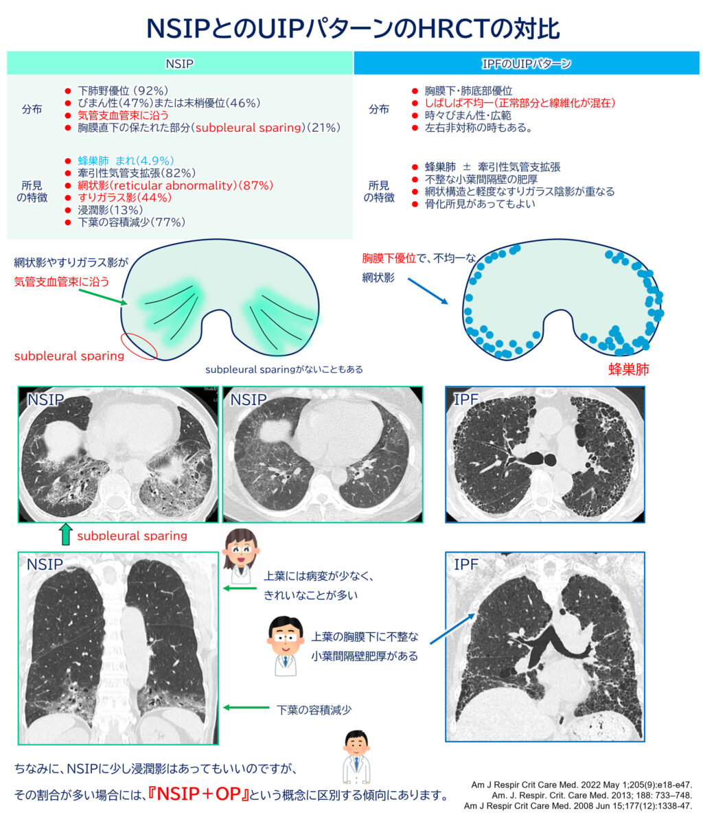 特発性NSIPとはどんなものか？ HRCTと病理について | 呼吸器内科医のブログ LungDr Note