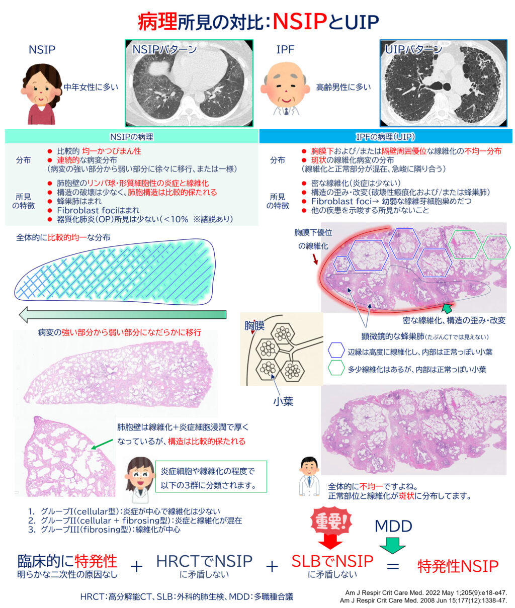 特発性NSIPの病理に焦点をあててみた | 呼吸器内科医のブログ LungDr Note