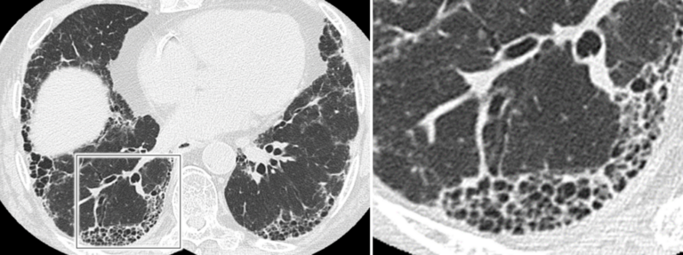 胸部HRCTで蜂巣肺・多発嚢胞・気腫を鑑別してみる | 呼吸器内科医のブログ LungDr Note
