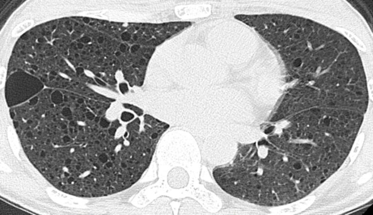 胸部HRCTで蜂巣肺・多発嚢胞・気腫を鑑別してみる | 呼吸器内科医のブログ LungDr Note