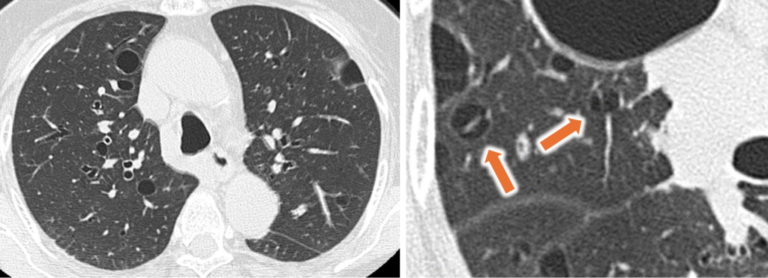 胸部HRCTで蜂巣肺・多発嚢胞・気腫を鑑別してみる | 呼吸器内科医のブログ LungDr Note
