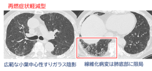 過敏性肺炎④～線維性過敏性肺炎（fHP）の画像診断をマスターしよう！ | 呼吸器内科医のブログ LungDr Note