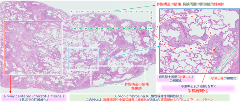 過敏性肺炎⑦～線維性過敏性肺炎の病理像をやさしく解説します | 呼吸器内科医のブログ LungDr Note
