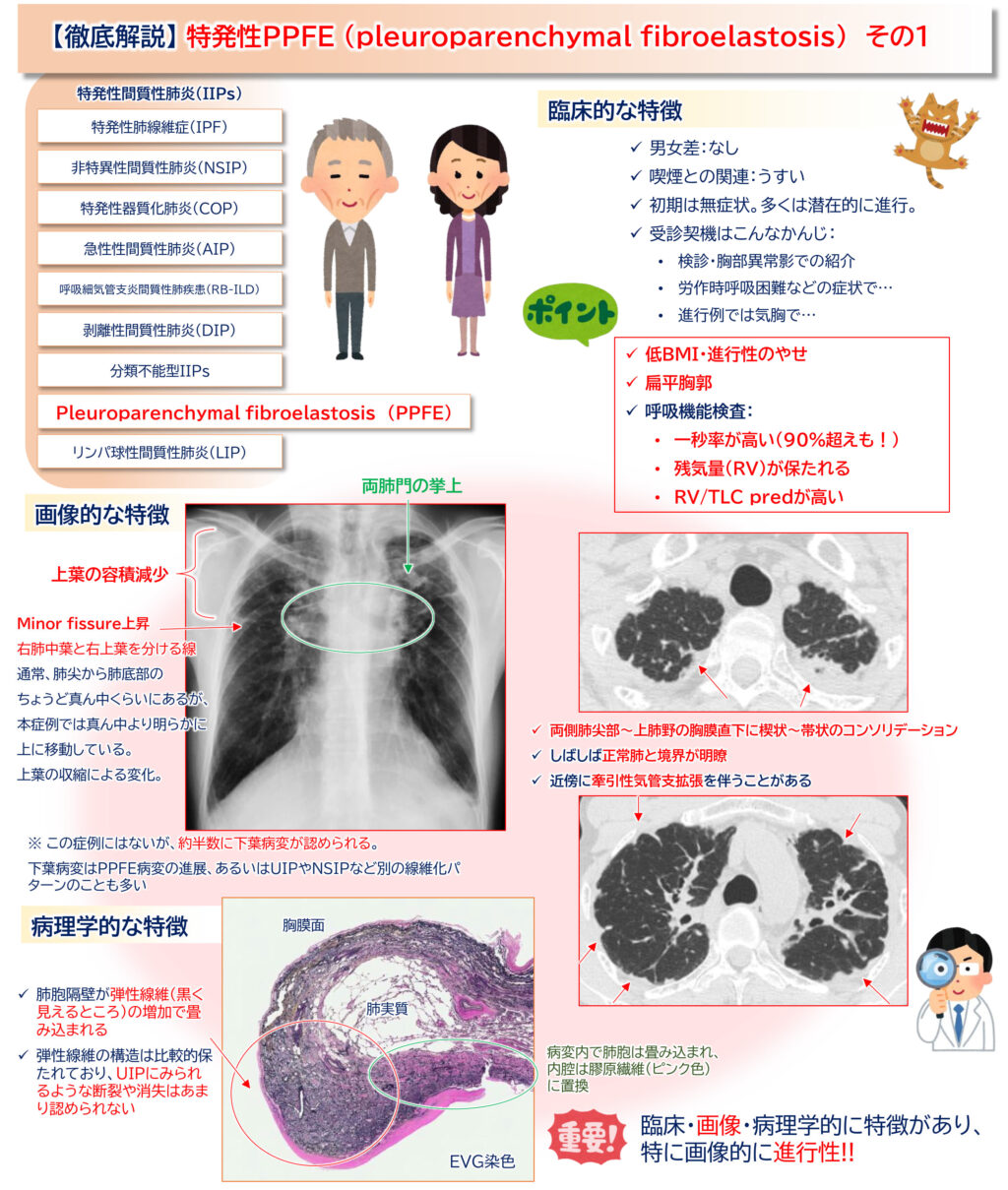 特発性Pleuroparenchymal Fibroelastosis（iPPFE）をやさしく解説①―疾患概念と臨床像について | 呼吸器内科医のブログ LungDr Note
