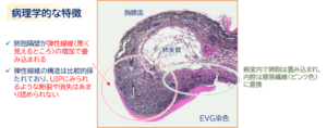 特発性Pleuroparenchymal Fibroelastosis（iPPFE）をやさしく解説①―疾患概念と臨床像について | 呼吸器内科 ...
