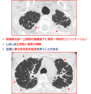 特発性Pleuroparenchymal Fibroelastosis（iPPFE）をやさしく解説①―疾患概念と臨床像について | 呼吸器内科 ...