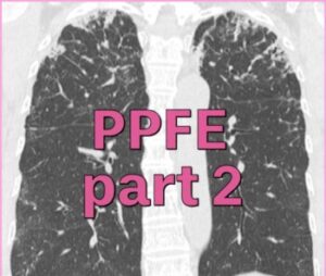 特発性Pleuroparenchymal Fibroelastosis（iPPFE）をやさしく解説②―画像と病理所見、下葉病変の意義 | 呼吸 ...