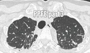特発性Pleuroparenchymal Fibroelastosis（iPPFE）をやさしく解説③―診断と二次性PPFE | 呼吸器内科医の ...