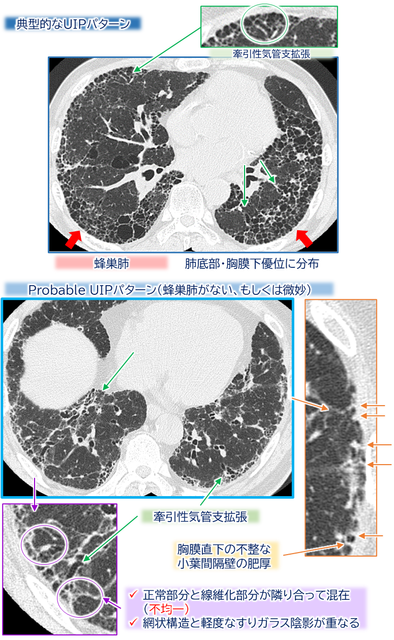 【新国際分類2025】その4 Usual Interstitial Pneumonia（UIP）はただの画像・病理パターン―“特発性”か“二次 ...