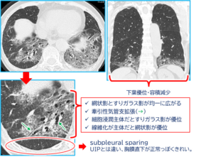 【新国際分類2025】その5 Nonspecific interstitial pneumonia（NSIP） | 呼吸器内科医のブログ LungDr Note