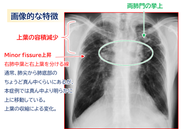 特発性Pleuroparenchymal Fibroelastosis（iPPFE）をやさしく解説②―画像と病理所見、下葉病変の意義 | 呼吸 ...