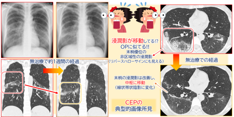【新国際分類2025】その15 慢性好酸球性肺炎（CEP）がステートメントに組み込まれたぞ。 | 呼吸器内科医のブログ LungDr Note
